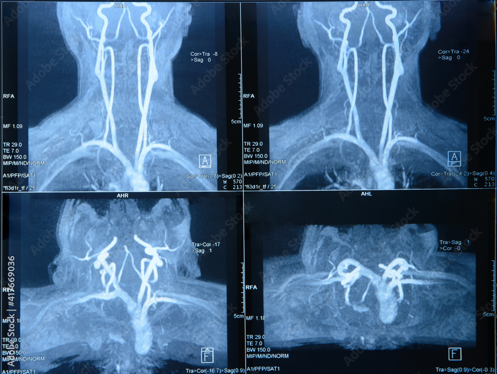 magnetic resonance non-contrast angiography of the neck vessels Stock ...