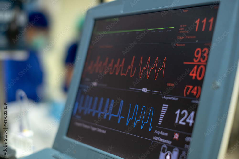 EKG monitor in intra aortic balloon pump machine. Medical equipment ...