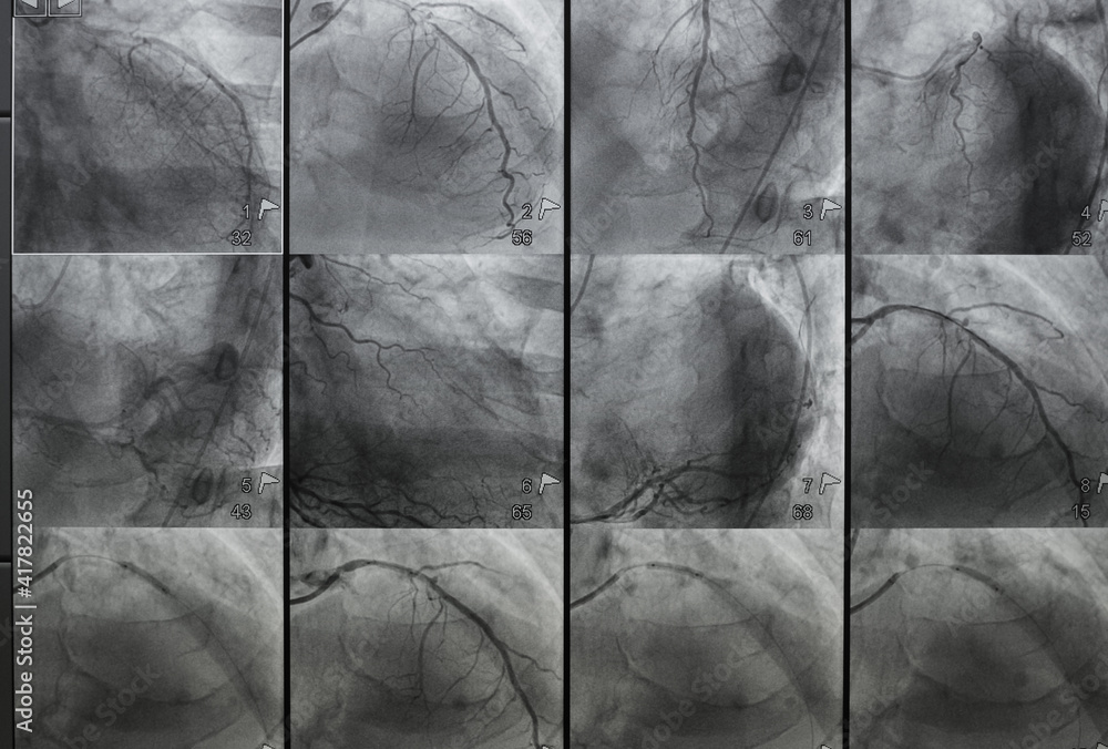 Coronary angiogram , medical x-ray for heart disease. Coronary artery ...