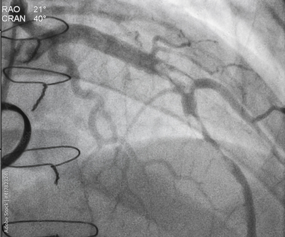 Coronary angiogram , medical x-ray for heart disease. Coronary artery ...