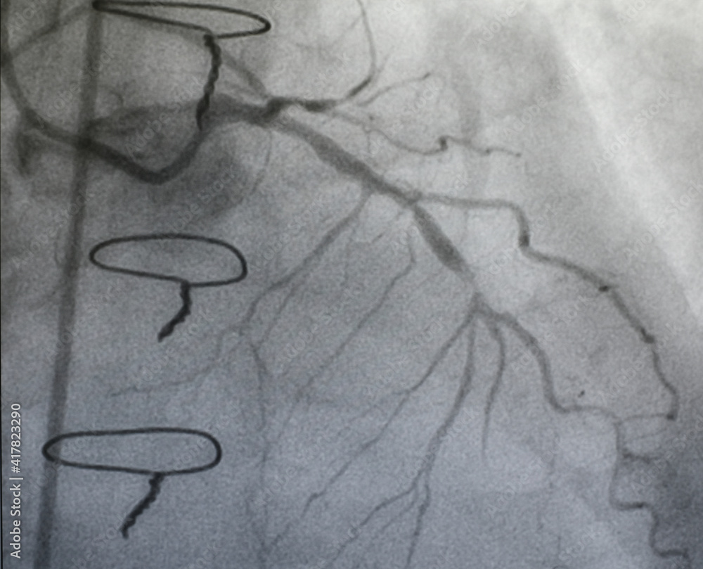 Coronary angiogram , medical x-ray for heart disease. Coronary artery ...