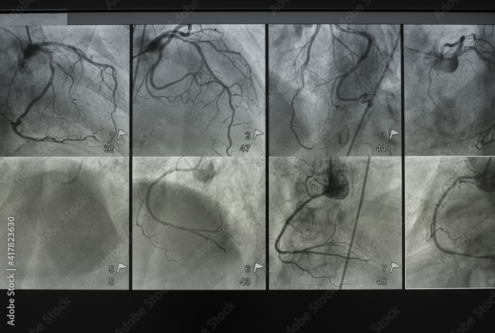 Coronary angiogram , medical x-ray for heart disease. Coronary artery ...