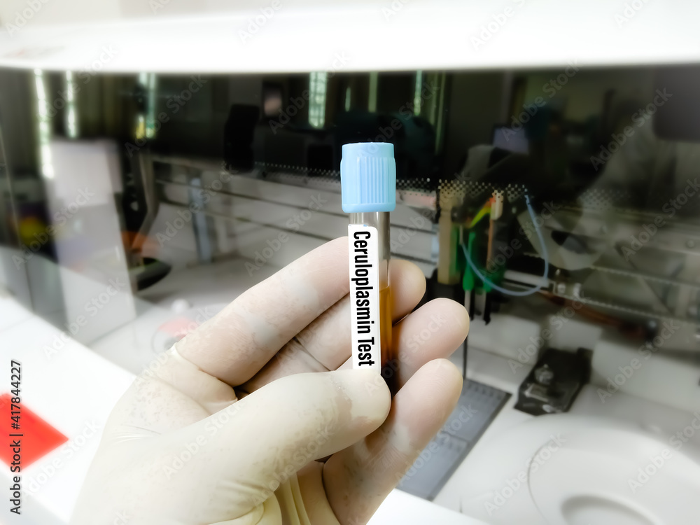 Doctor holding a test kit for mosquito-borne infectious disease malaria ...
