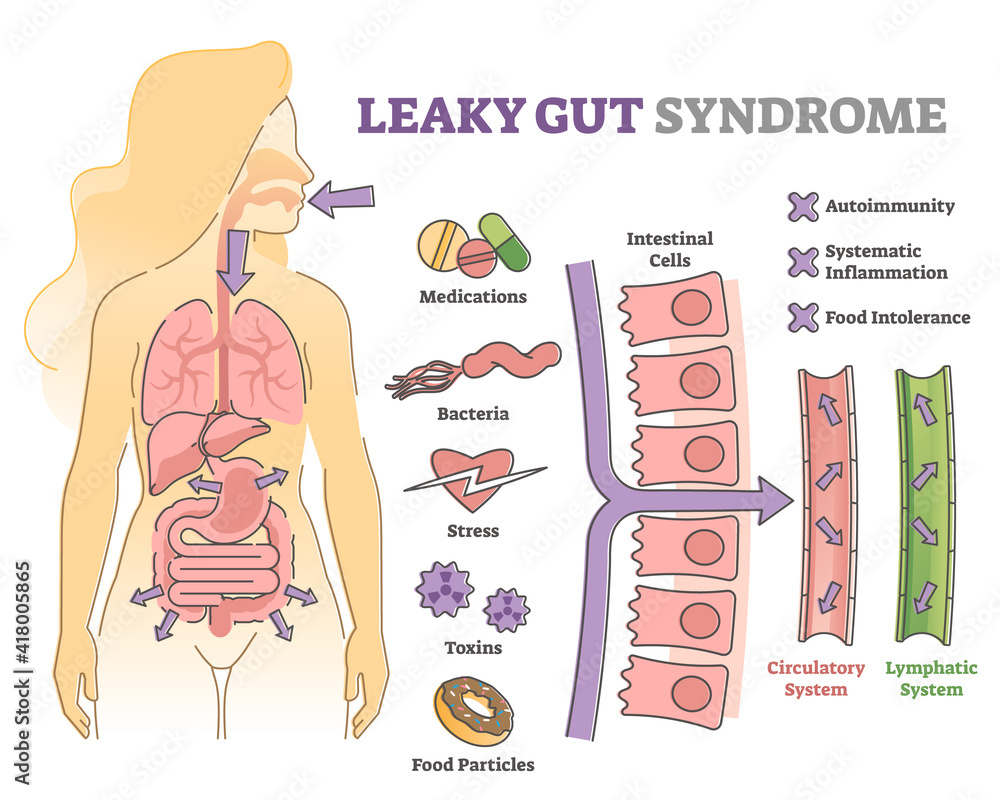 Plagát Leaky gut syndrome as immune system reaction to environment ...
