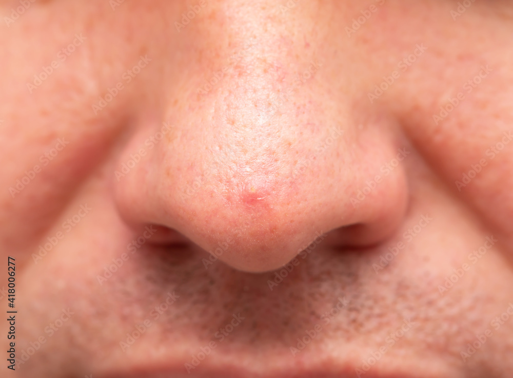 acne on the skin of the nose Stock Photo | Adobe Stock