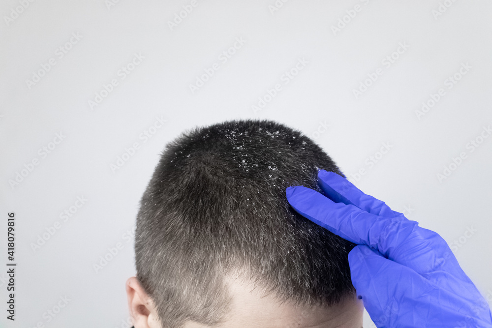 Dandruff on a man's shoulder. Side view of a man who has more dandruff ...