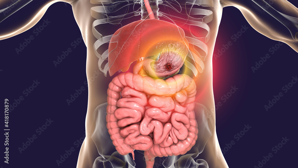 Peptic ulcer, stomach ulcer Stock Illustration | Adobe Stock