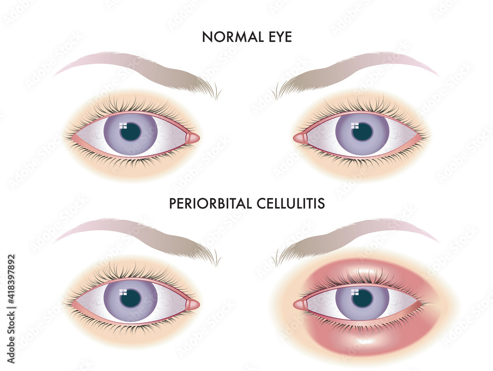 Medical illustration shows the comparison between normal eyes and those ...