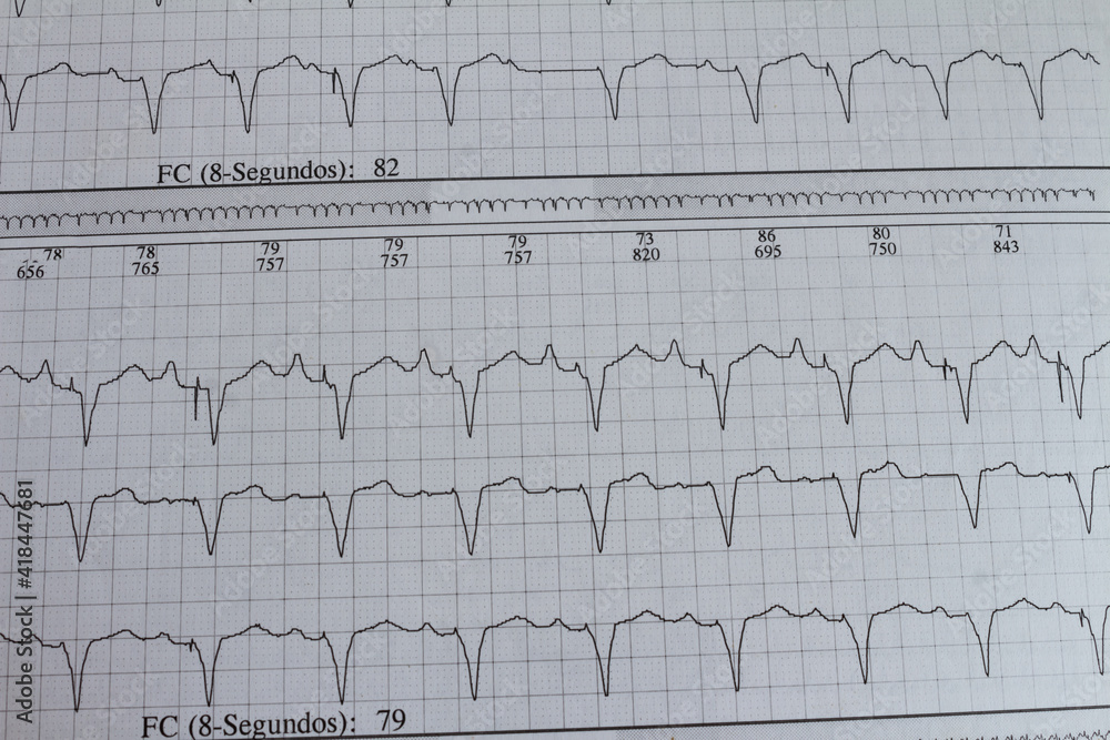 Electrocardiogram with cardiac arrhythmia. Patient with cardiac ...