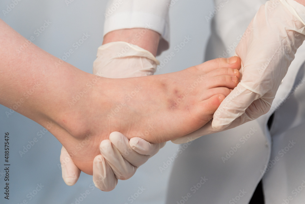 The doctor gently feels the child's foot. Bruises are visible on the ...