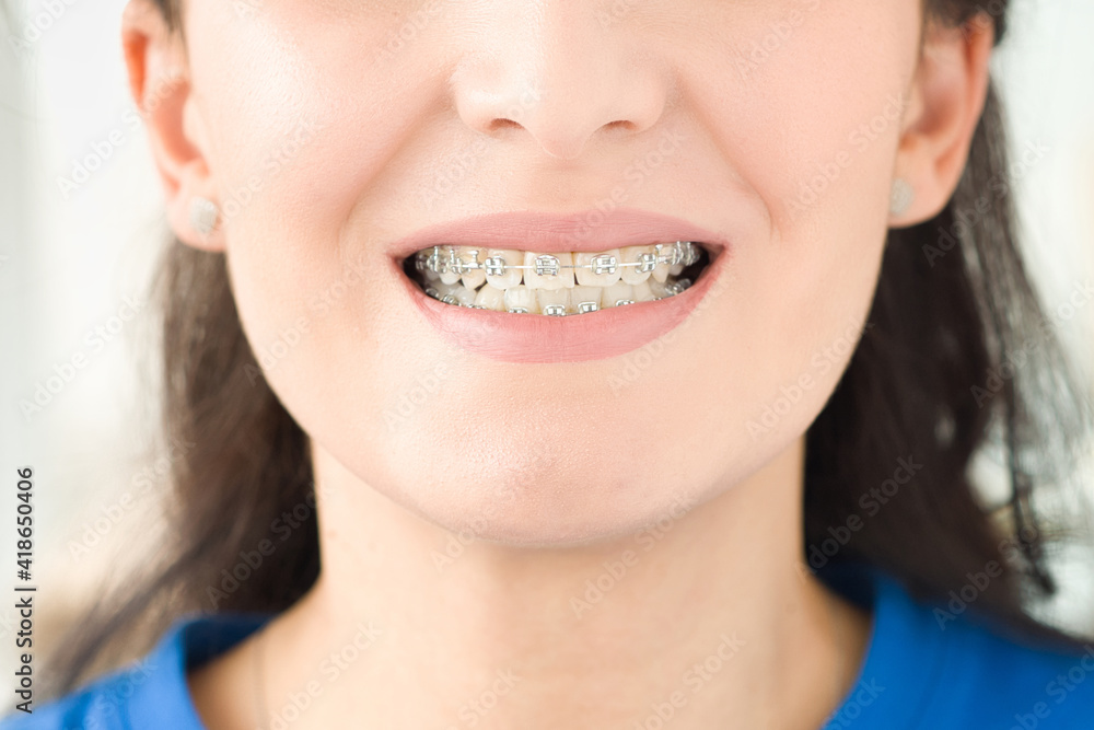 Wearing orthodontal dental brackets device mounted on woman face smile ...
