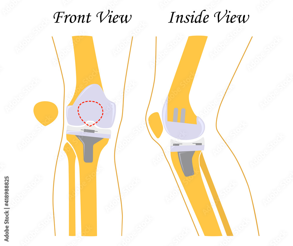 Knee replacement. Joint prosthetics. Knee endoprosthesis. Vector ...
