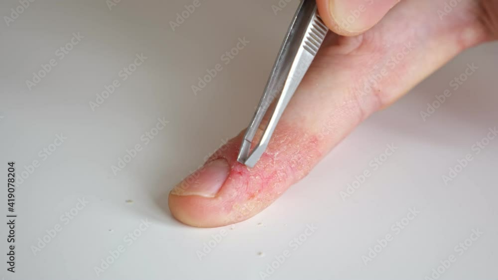 Vidéo Stock Doctor scrapes a skin with tweezers for analysis, close-up ...