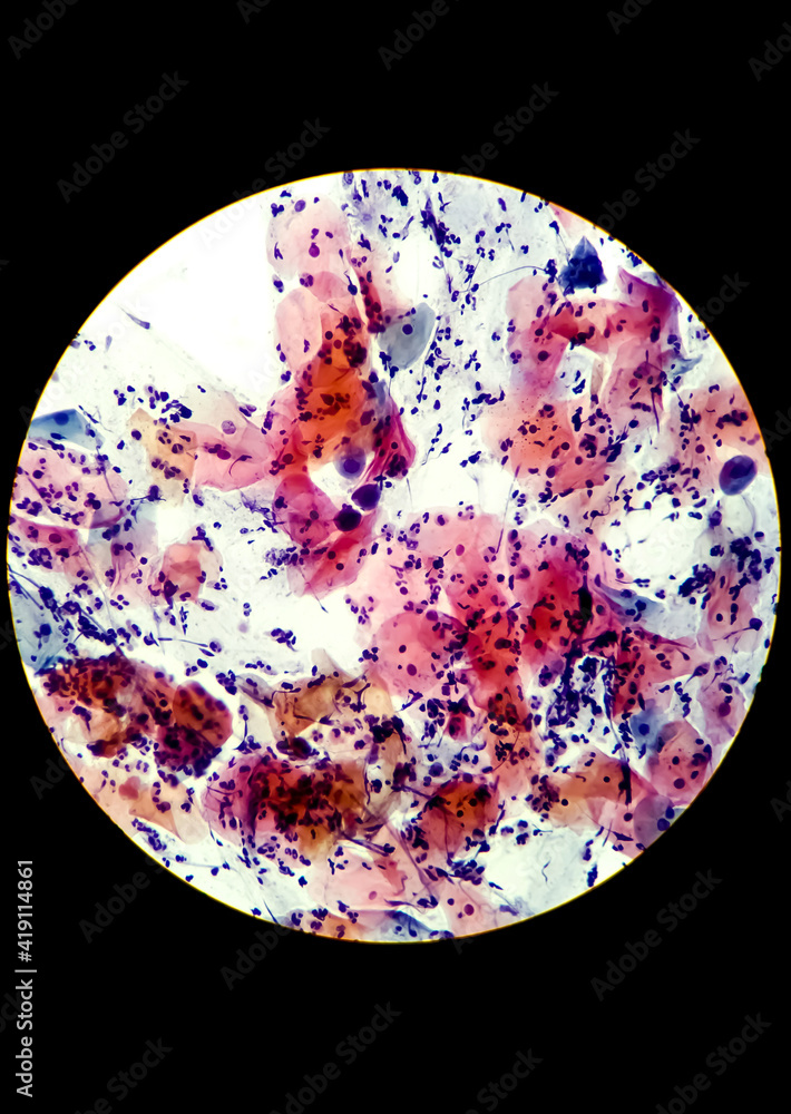 Normal squamous epithelial cells of cervical human view in microscopy ...
