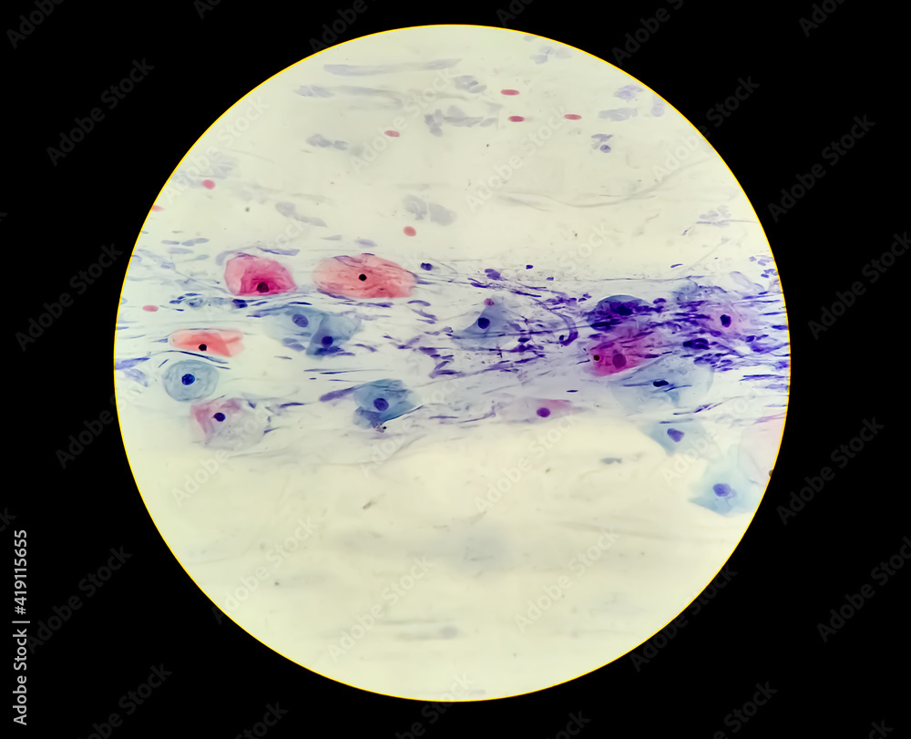 Normal squamous epithelial cells of cervical human view in microscopy ...