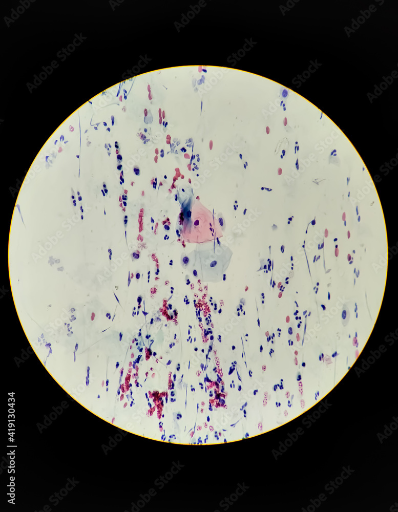 Normal squamous epithelial cells of cervical human view in microscopy ...