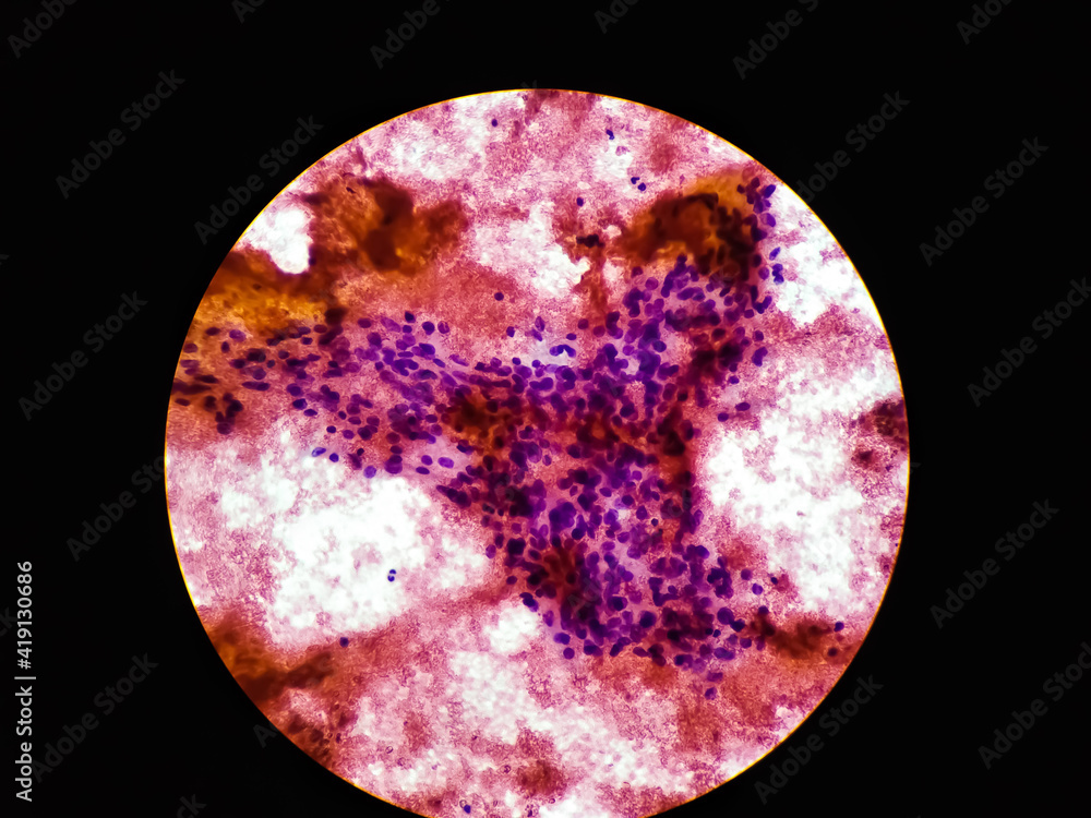 Dragon shape image cervicai lymph node tissue for cytopathology (FNAC ...