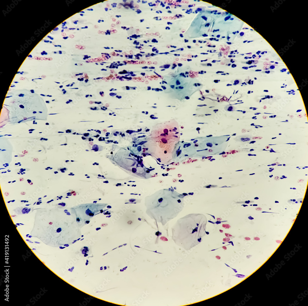 Normal squamous epithelial cells of cervical human view in microscopy ...