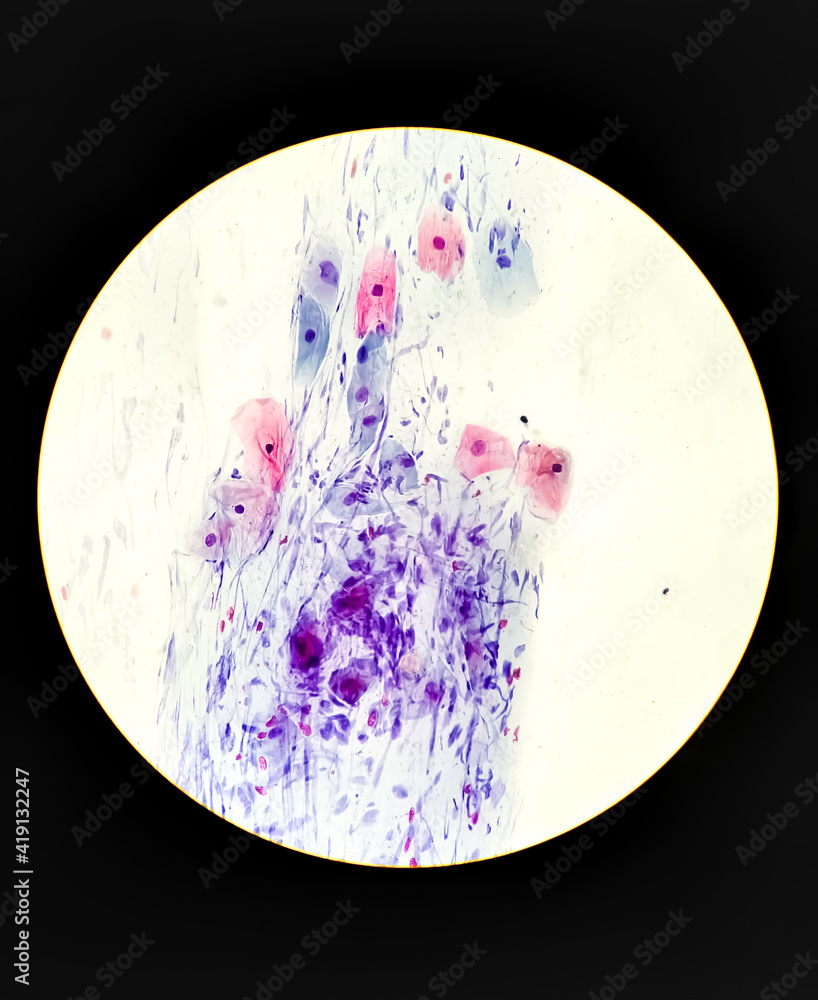 Normal squamous epithelial cells of cervical human view in microscopy ...