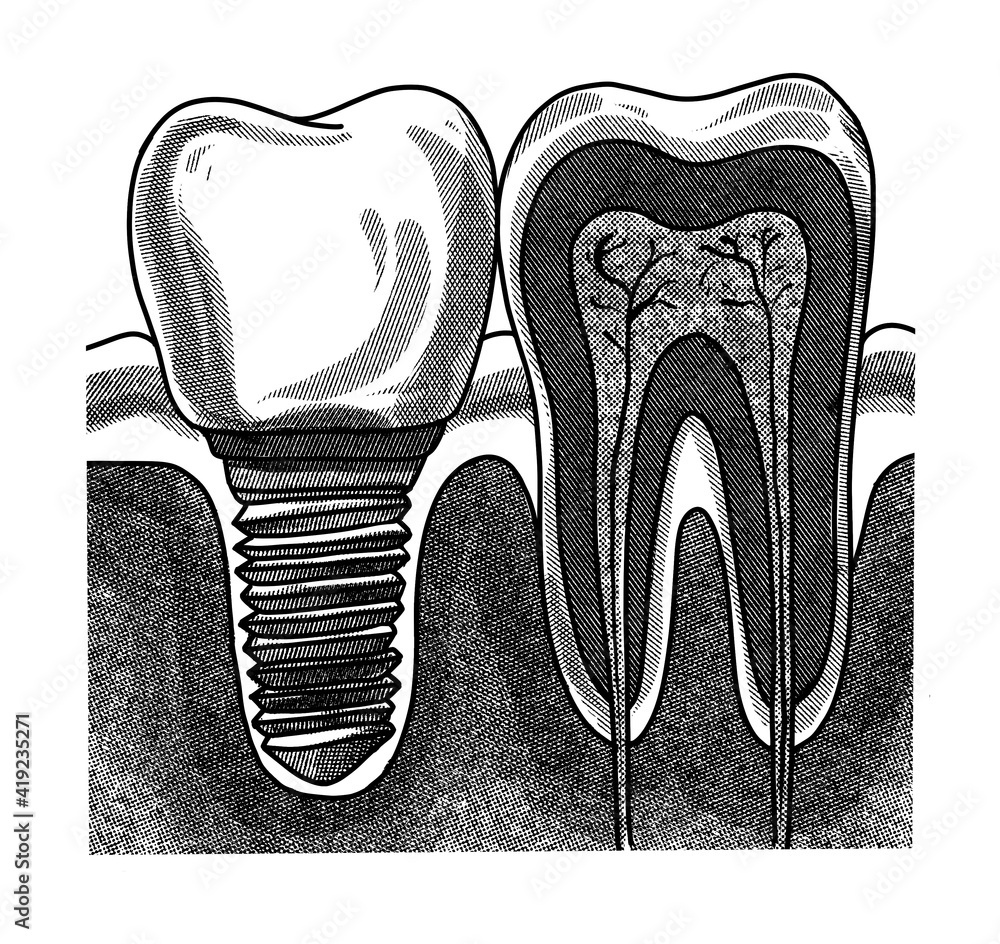 Hand drawing, line art, engraving, ink Dental Illustration. Vintage ...
