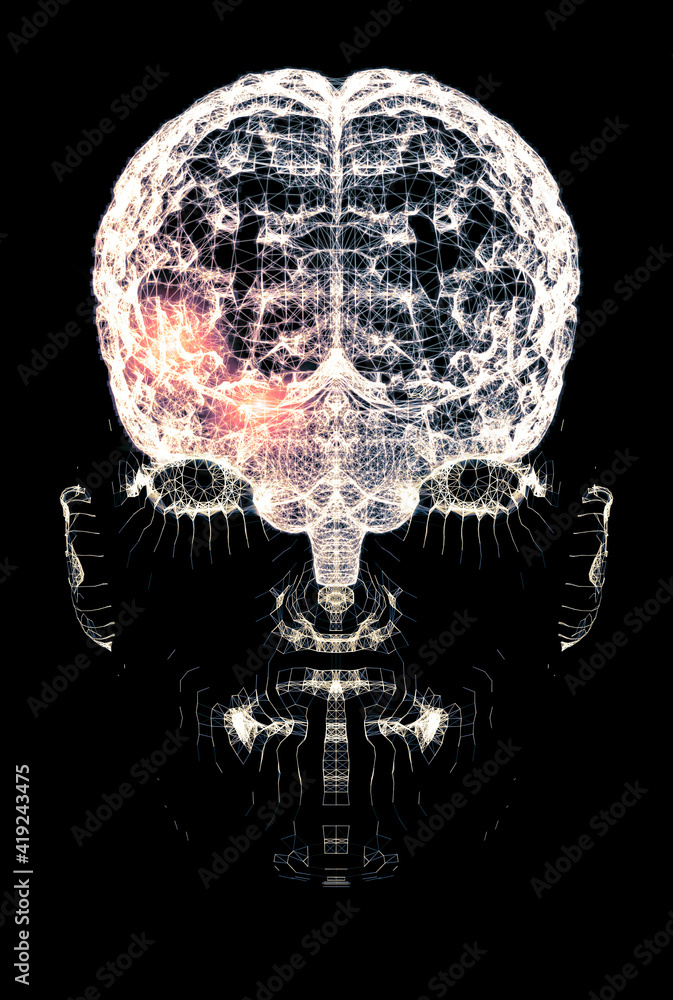 The appendix is a finger-like, blind-ended tube connected to the cecum ...