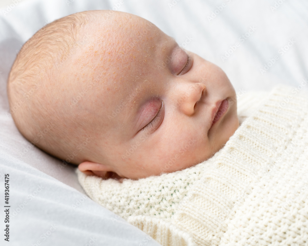 seborrheic dermatitis on the head of newborn baby. seborrhea atopic ...