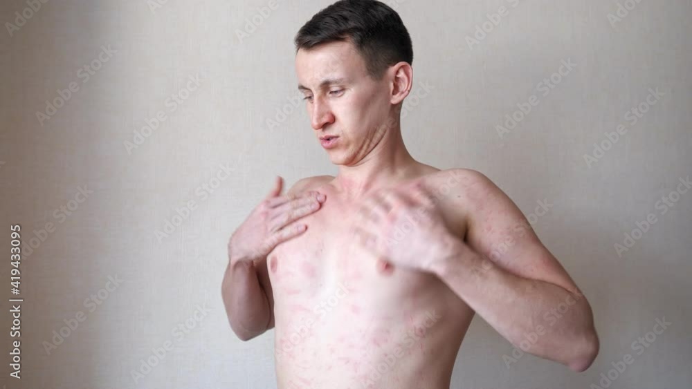Upset nervous young man scratches bare chest by hand suffering from ...