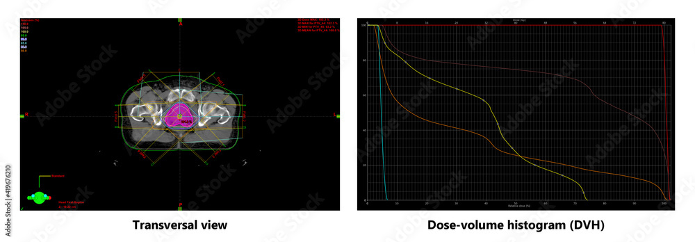 Prostate cancer 3D conformal technology radiotherapy medical ...