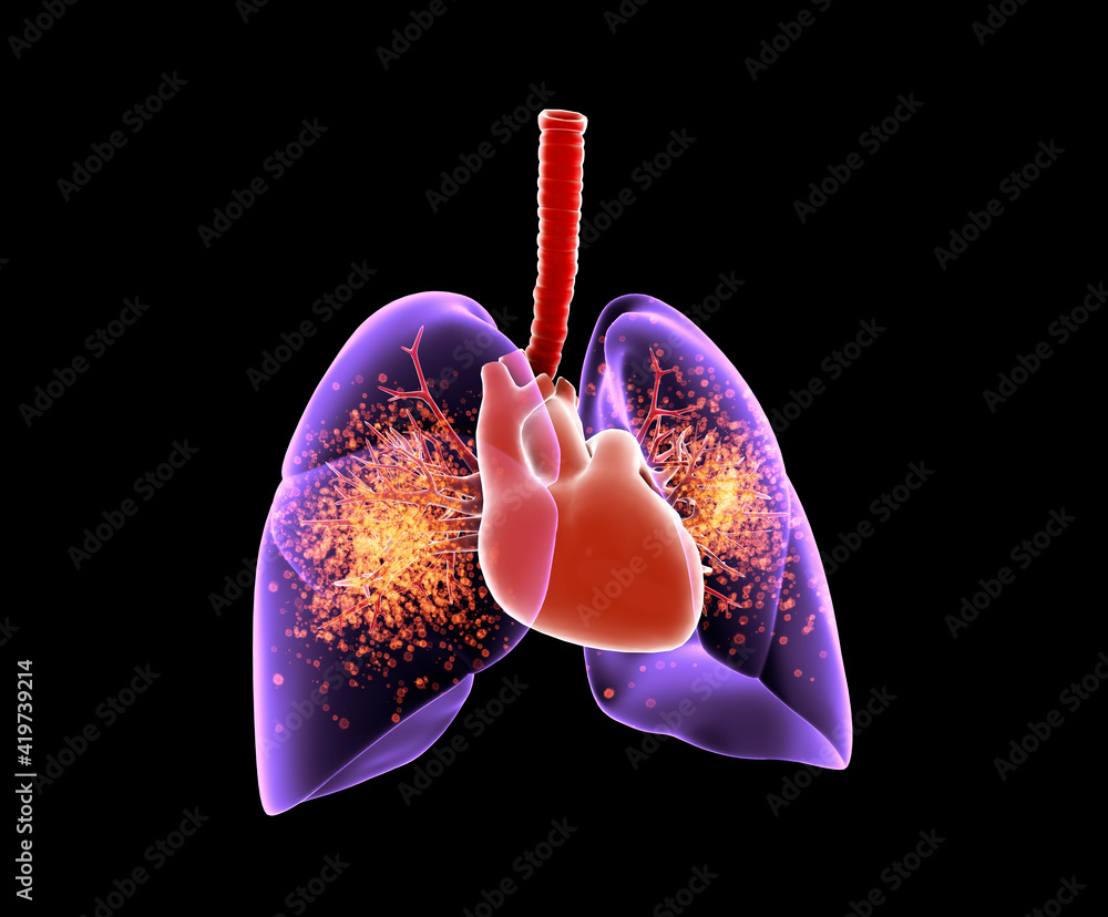 Inflamed lungs with virus particles, causing pain in the lungs, heart ...