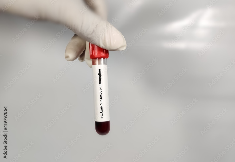 Test Tube with blood sample for Angiotensin-converting enzyme (ACE ...