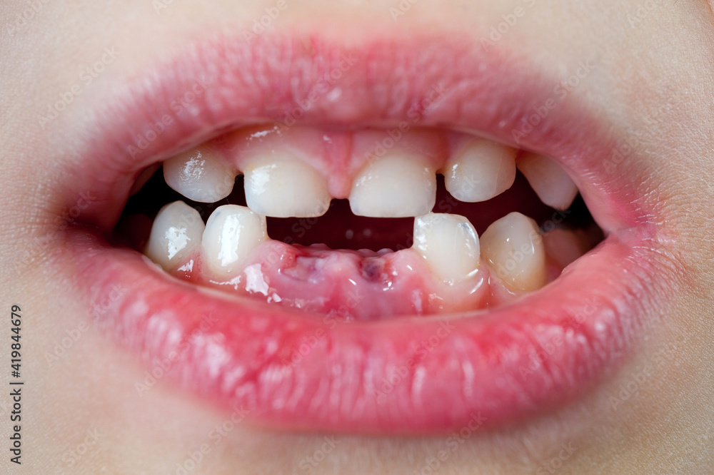 Child's mouth with two anterior lower milk teeth pulled out. Stock ...