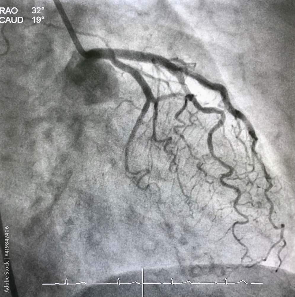 Normal coronary angiogram of left coronary artery during cardiac ...