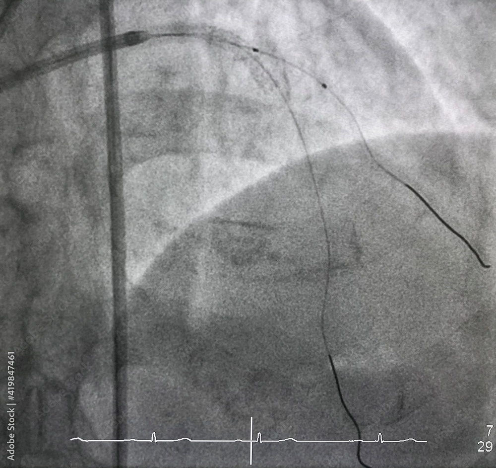 Compliant balloon catheter was at proximal left anterior descending ...