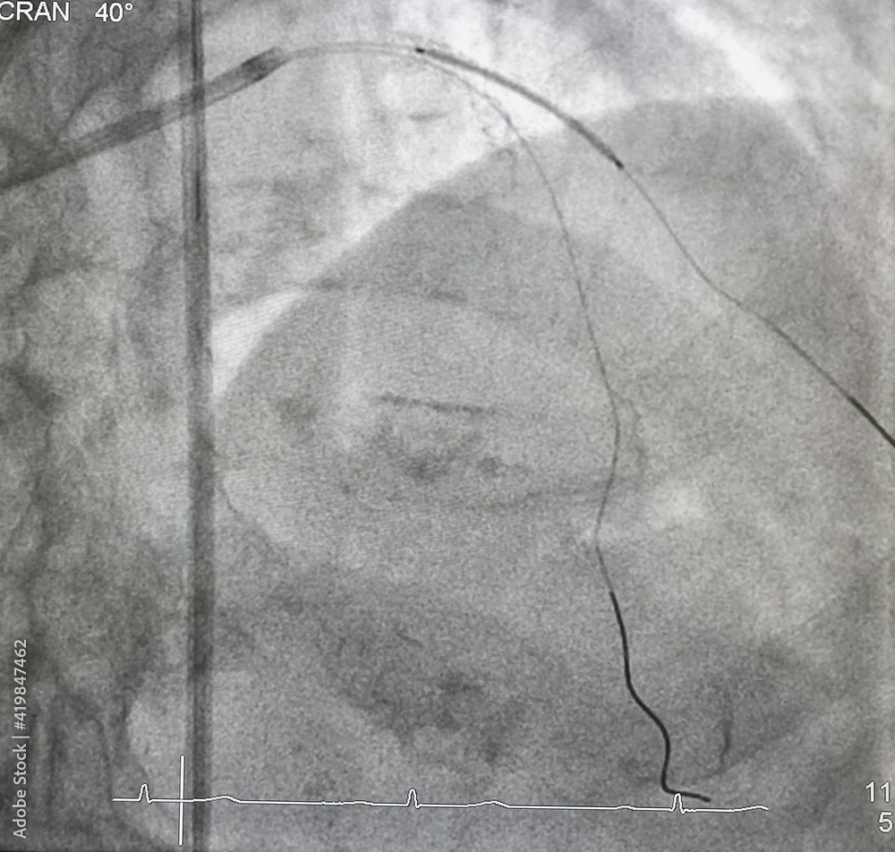 Drug eluting stent (DES) deployed at left anterior descending artery ...