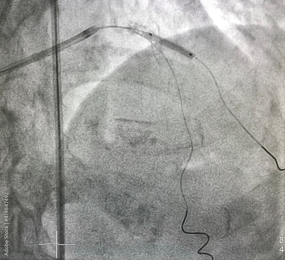Poster Compliant balloon catheter was inflated at proximal left ...