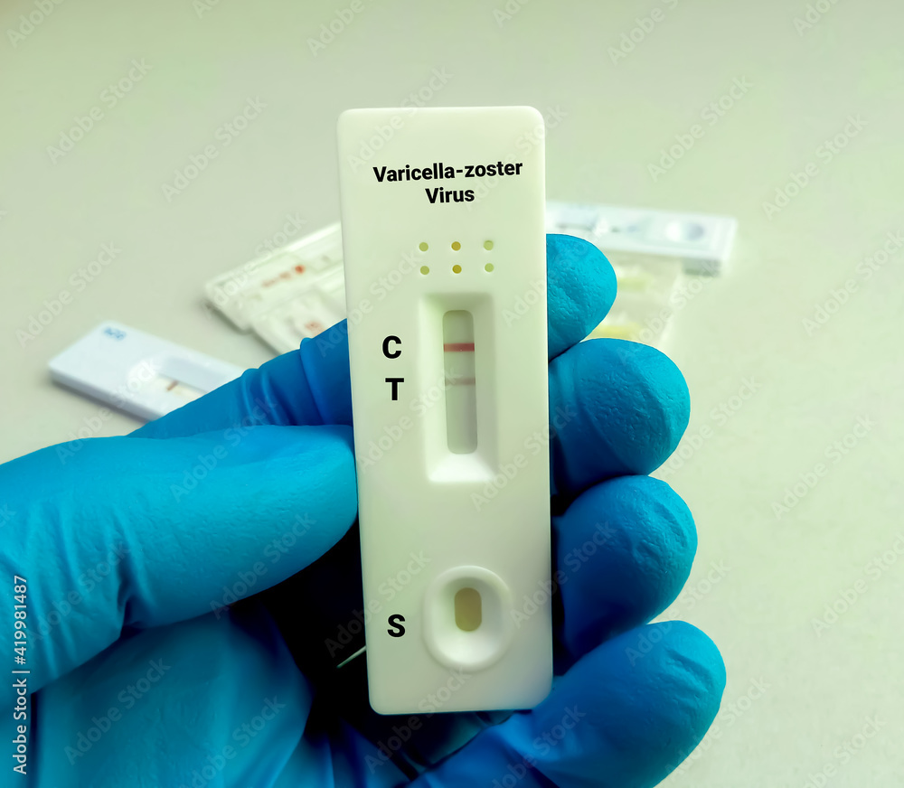 Foto de Hand hold a device of varicella-zoster virus (VZV) Virus rapid ...