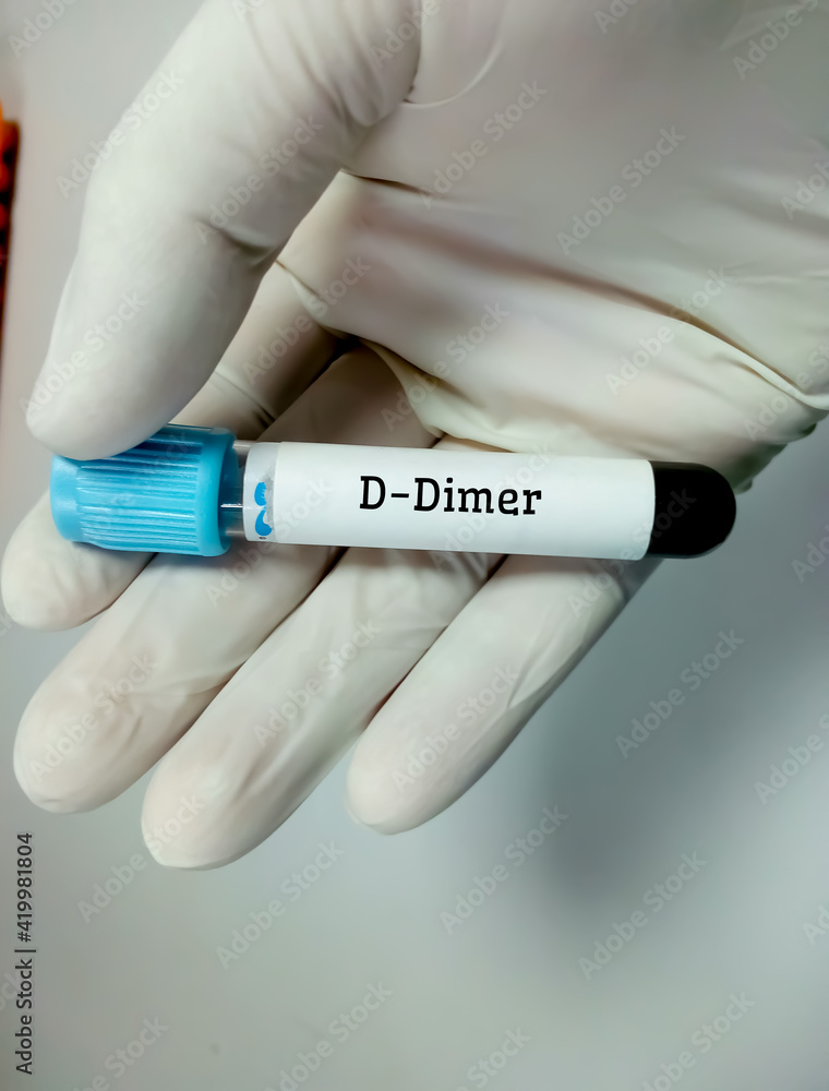 D-Dimer test. Corona patient monitoring test in ICU. Doctor or ...
