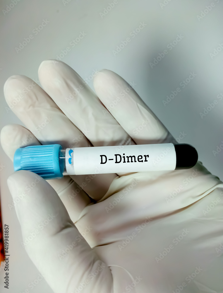 D-Dimer test. Corona patient monitoring test in ICU. Doctor or ...