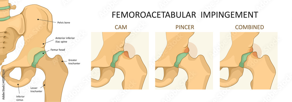 Femoroacetabular impingement (FAI). Front view of hip joint with ...
