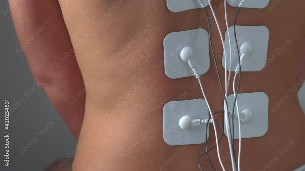 Physiotherapy of the back with TENS electrode pads, external electrical ...