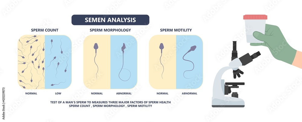 in vitro fertilization IVF semen test sample sperm count type Male ...