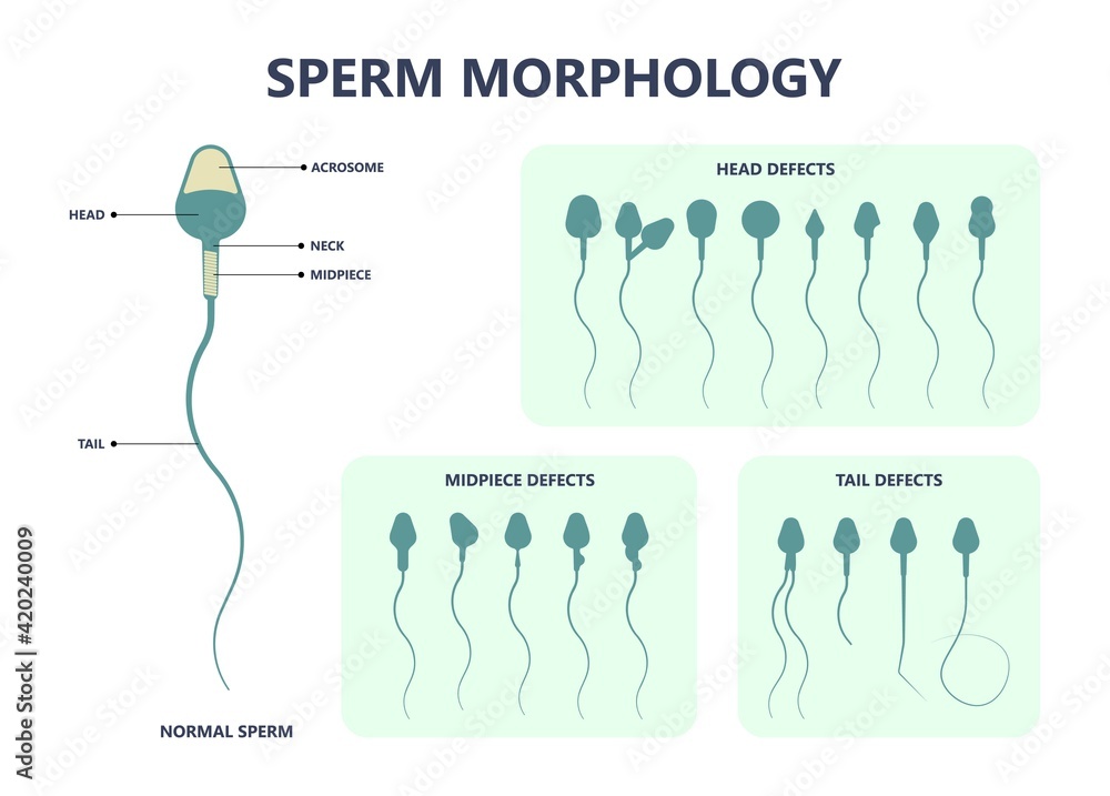 in vitro fertilization IVF semen test sample sperm count type Male ...