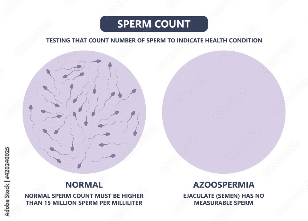 in vitro fertilization IVF semen test sample sperm count type Male ...