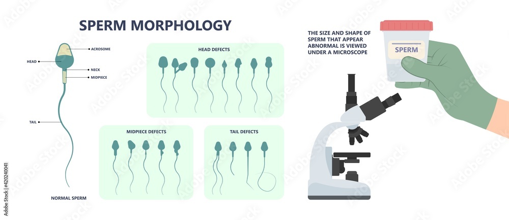 in vitro fertilization IVF semen test sample sperm count type Male ...