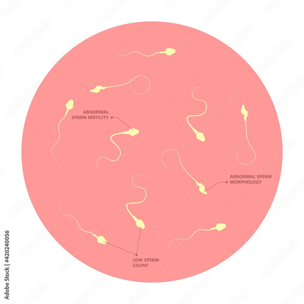 in vitro fertilization IVF semen test sample sperm count type Male ...
