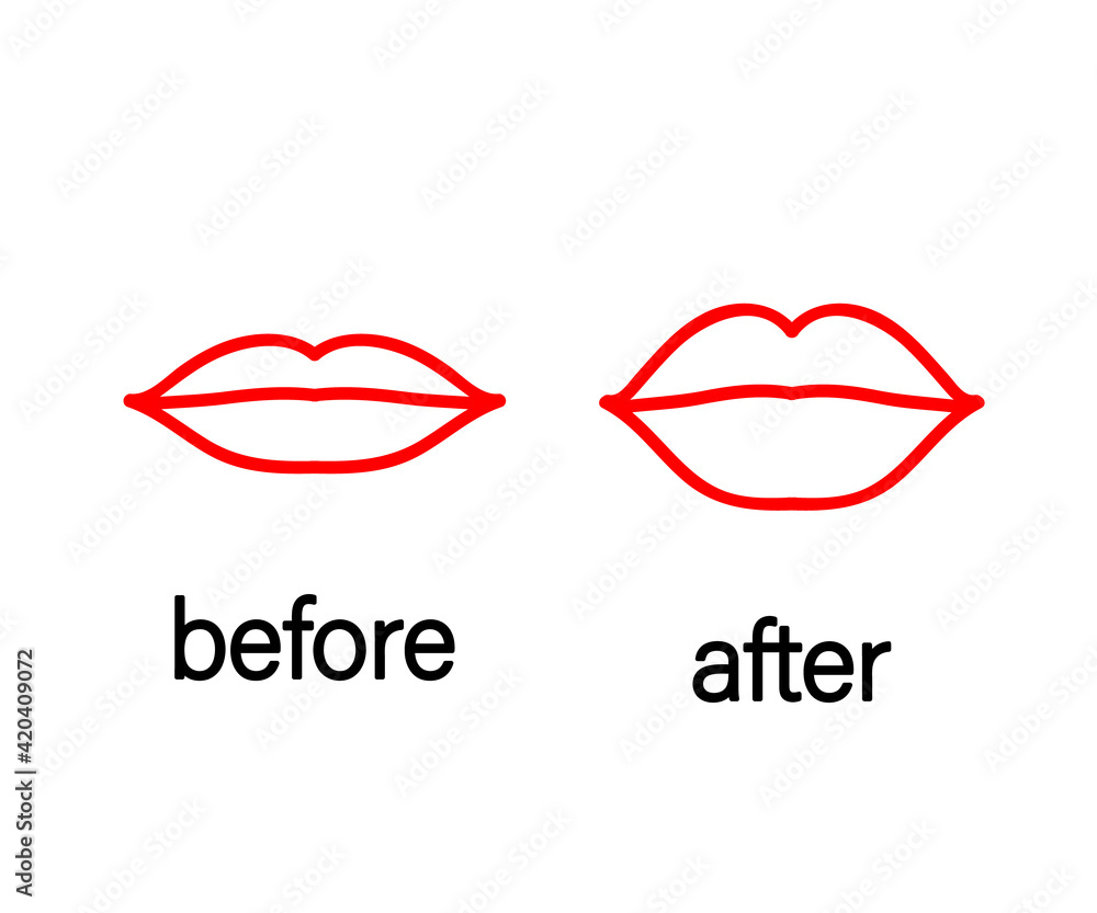 Lips before and after botox injection. Symbol. Vector illustration ...