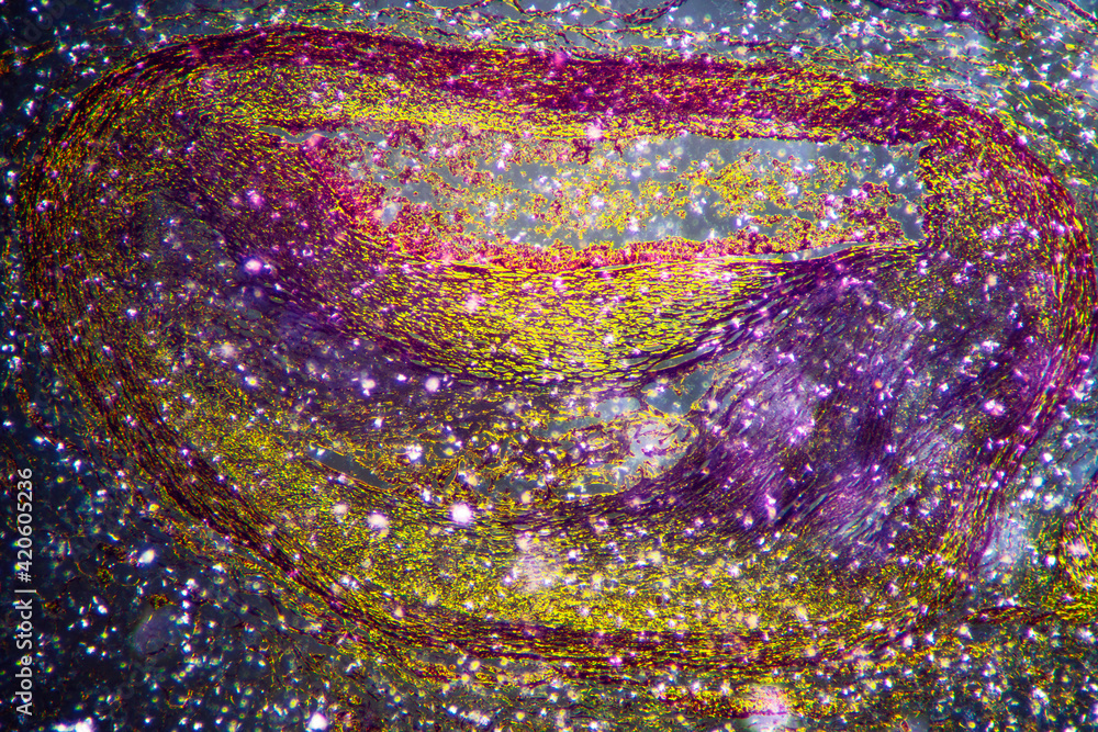 micrograph of human coronary artery atherosclerosis cells Stock Photo ...