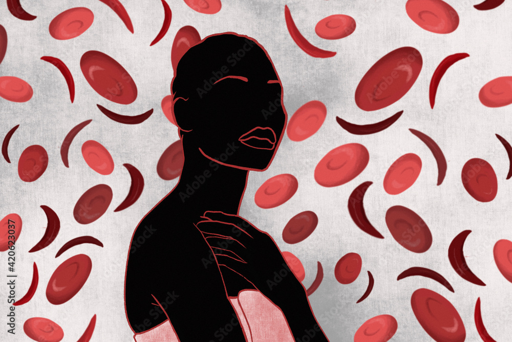 Sickle cell illustration Stock Illustration | Adobe Stock