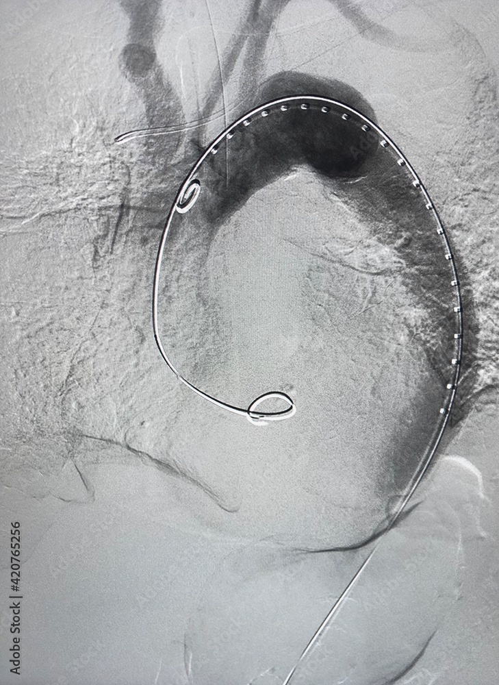 Angiogram of aorta shown aortic dissection type B at descending aorta ...