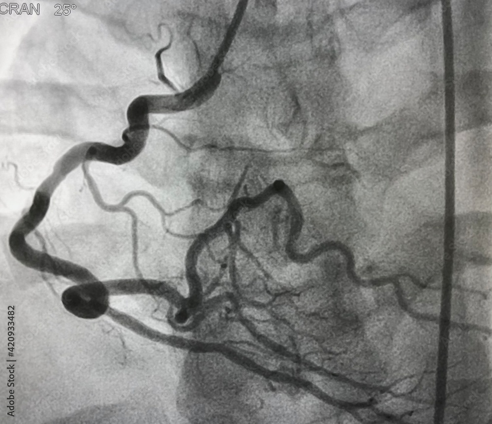 Coronary angiogram shown coronary ectasia at right coronary artery (RCA ...